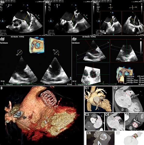 Left Atrial Appendage Occlusion Eurointervention