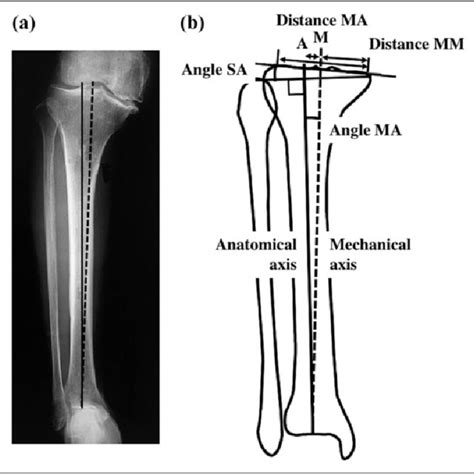 A A Tibial Component Is Set Perpendicular To Anatomical Axis B A Download Scientific