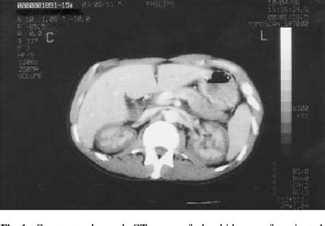 Figure 1 From Acute Cortical Necrosis In Acquired Immunodeficiency Syndrome Aids Semantic
