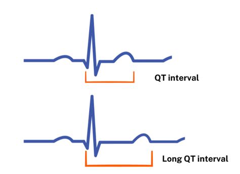 Qtc Interval Long Qt Syndrome By G Dhillon Openpediatrics