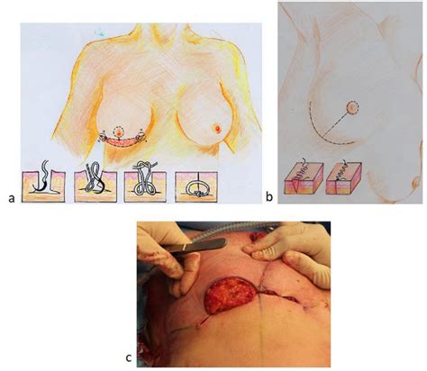The Subcutaneous Buried Sutures Were Placed First From Both Corners