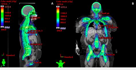 Patients Total Marrow Irradiation Treatment Plan With A A Sagittal Download Scientific