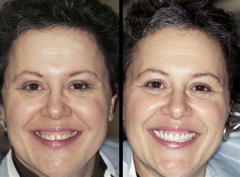 Gummy Smile Fixed Gum Lift Porcelain Veneers Ny Cosmetic Dentists