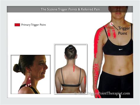 The Scalene Trigger Points Upper Body Troublemakers