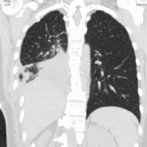 Control Ct Scan That Shows Lung Parenchyma Window 10 Days After Download Scientific Diagram