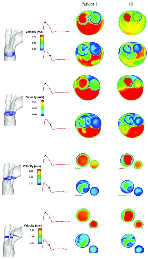 Comparison Between Patient 1 And Model 1b Of Instantaneous Velocity