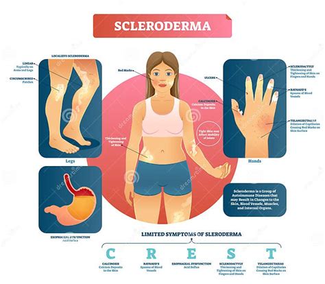 Scleroderma Vector Illustration Autoimmune Skin And Blood Disease