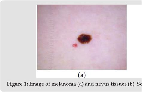 Figure 1 From Analysis And Classification Of Skin Spot Images By Extraction Of Texture