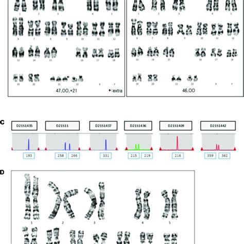 Qf Pcr And Conventional Karyotyping Results In Case 1 A Qf Pcr