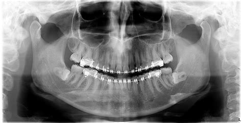 Recessed Upper Jaw Ljs Djs Rjawsurgery