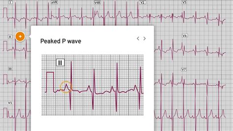 Ventricular Septal Defect Ecg