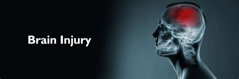 Traumatic Brain Injury Long Term Effects Symptoms And 57 Off