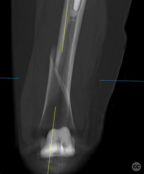 Rorabeck Ii Vancouver C Inter Implant Periprosthetic Femur Fracture