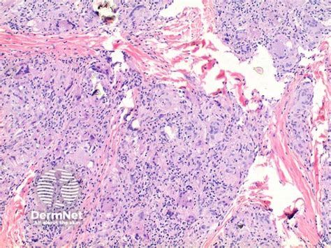 Sarcoidosis Pathology