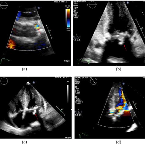 Axial Gradient Recall Echo Gre Imaging Demonstrated Multiple Punctate