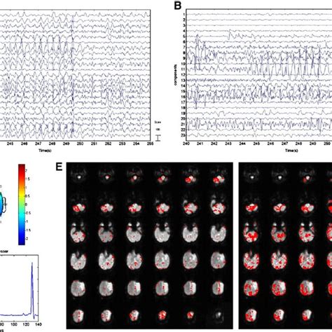 Patient A EEG Signal After Pre Processing B EEG Components Download Scientific Diagram