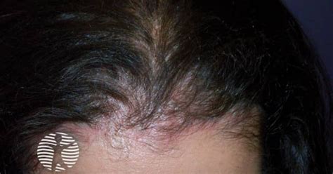 Psoriasis Of The Scalp Image