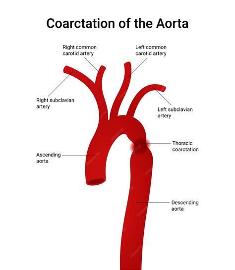 Premium Vector Schematic Diagram Of Aortic Coarctation