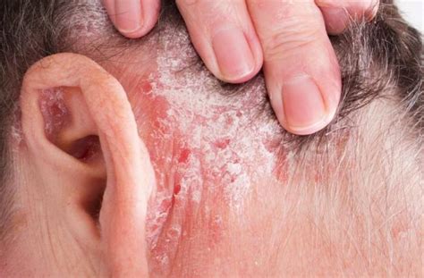 Qué Es La Psoriasis Síntomas Causas Y Tratamiento Natursan