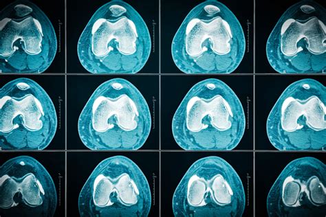 Could Ultra Low Dose Ct Scan Do The Trick Kinomatic