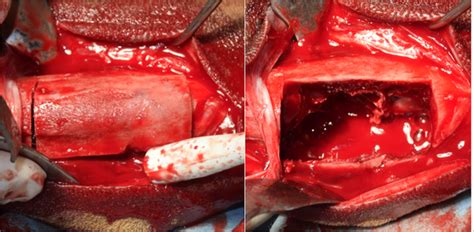 A Corticotomy Was Performed In The Radius And The Bone Cyst Cavity Was Download Scientific