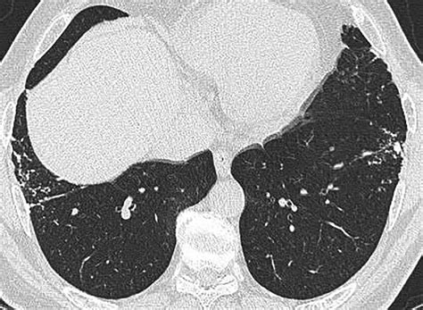 Dendriform Pulmonary Ossification In The Absence Of Usual Interstitial