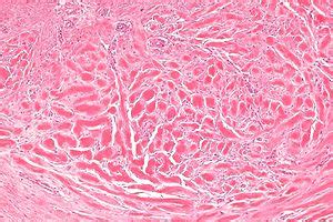 Keloid Libre Pathology