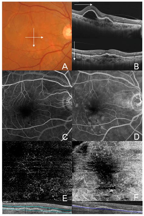 Multimodal Imaging Of A 63 Year Old Female Showing Type 1 Choroidal