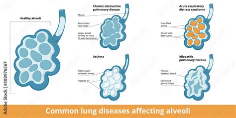 Plakat Common Alveoli Damages Differences Between Changes Caused By Lung Diseases Chronic