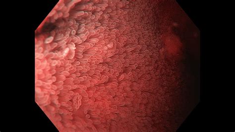 Normal Duodenal Mucosa Under Water Egd Nbi Zoom Youtube