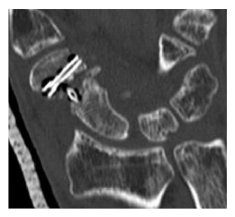 Ct Scan Taken 6 Weeks After Triscaphoid Arthrodesis Download
