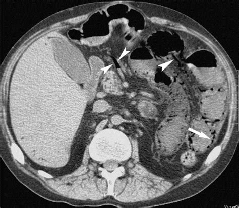 Acute Bowel Ischemia Ct Findings European Journal Of Radiology