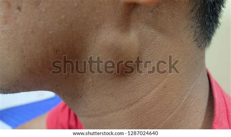 Preauricular Swelling Differential Diagnosis Parotid Swelling Foto De Stock 1287024640