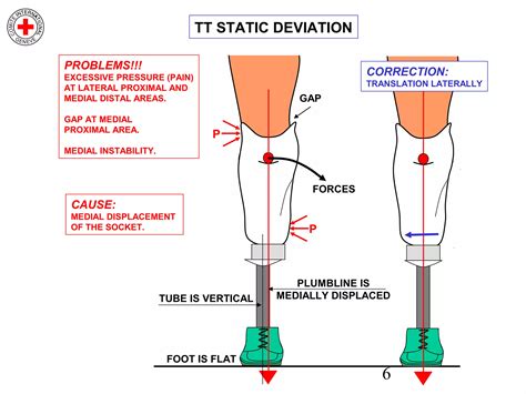 Transtibial Static Alignment Ppt Transtibial Static Alignment Ppt