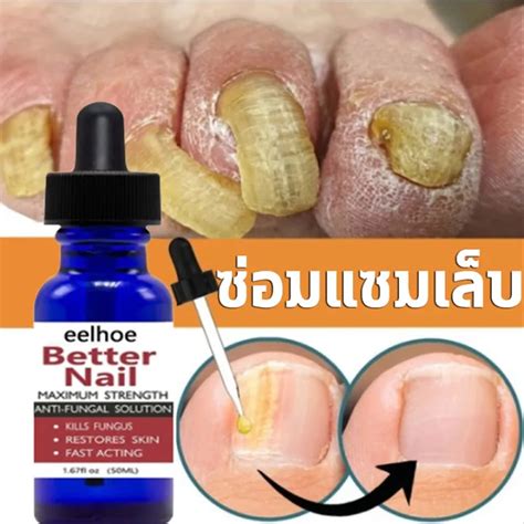 Eelhoe เซรั่มบำรุงเล็บ รักษาเชื้อราเล็บ ยารักษาเชื้อราเล็บ ยาเชื้อราเล็บ ยารักษาเล็บ เชื้อราที่