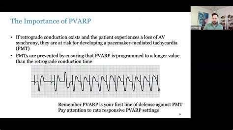 Ep9 Dual Chamber Pacemaker And Icd Timing Cycles Cvef Cardiac Device Ep Lecture Series Youtube