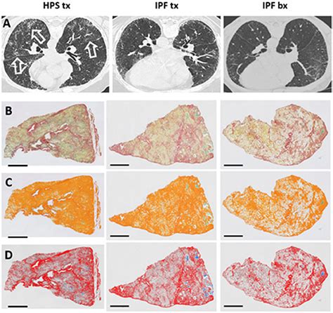 Frontiers Automated Digital Quantification Of Pulmonary Fibrosis In Human Histopathology Specimens