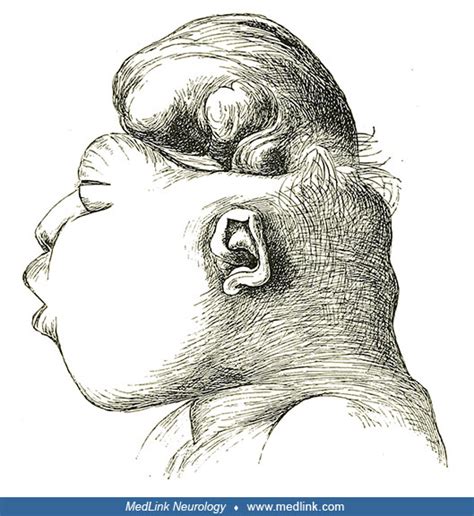 Anencephaly And Other Neural Tube Defects Medlink Neurology