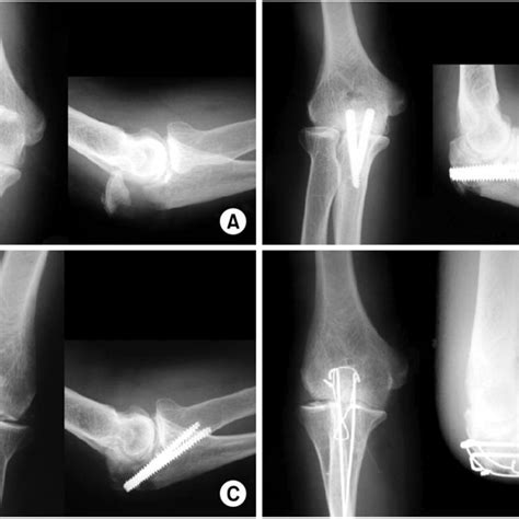 A Radiographs Show Olecranon Fracture Of Type Iia B These Download Scientific Diagram