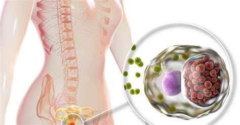 ¿qué Es La Clamidiasis El Hit Guate