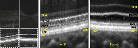 41 Visualization Of Outer Retina By Ao Oct System Four Outer Retinal