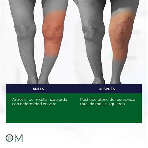 Compartimos Con Ustedes Un Caso De Reemplazo Total De Rodilla Nuestra Paciente Presentaba