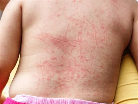 What Is Petechiae