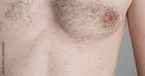 Pityriasis Versicolor Skin Disease Fungus On The Body Rash On The