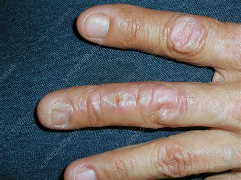 Linear Lichen Planus Stock Image C056 4852 Science Photo Library