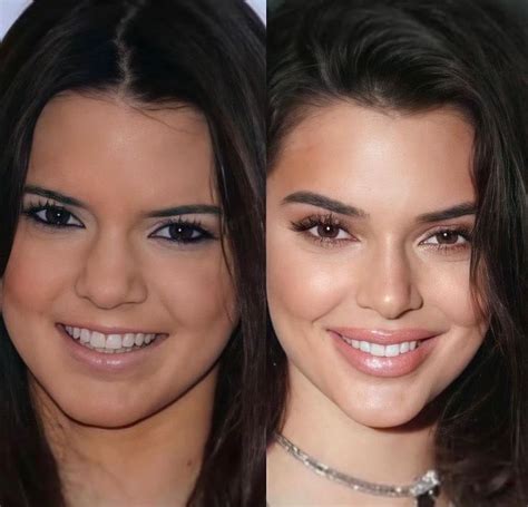 Plastic Surgery Isnt An Insult On Instagram Kendall Jenner What I