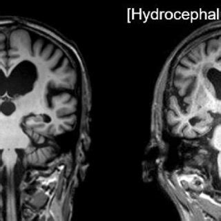 Pdf Differences In Brain Morphology Between Hydrocephalus Ex Vacuo