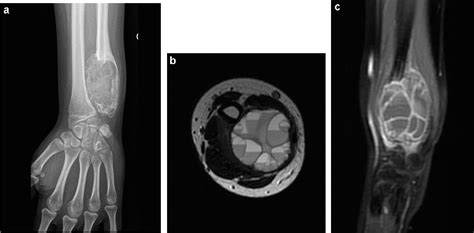 Figure 2 From Bone Cysts Unicameral And Aneurysmal Bone Cyst Semantic Scholar