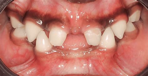 X Linked Hypohidrotic Ectodermal Dysplasia Type 1 An Uncommon Paediatric Genetic Case Report