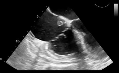 Giant Thebesian Valve Appearing As A Right Atrial Mass Journal Of Cardiothoracic And Vascular
